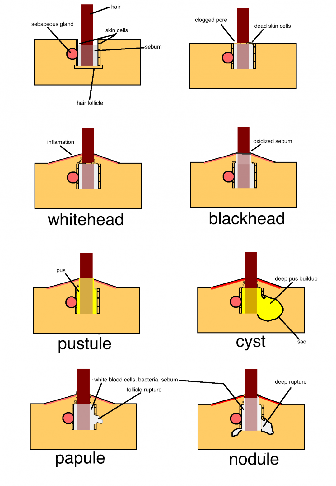 Acne: What is it and What causes Acne - Key To Perfect Health
